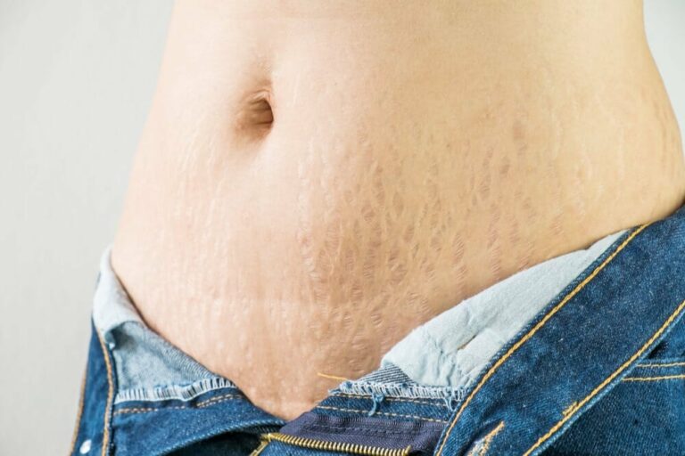 Microneedling - the solution to stretchmarks - London Premier Laser ...