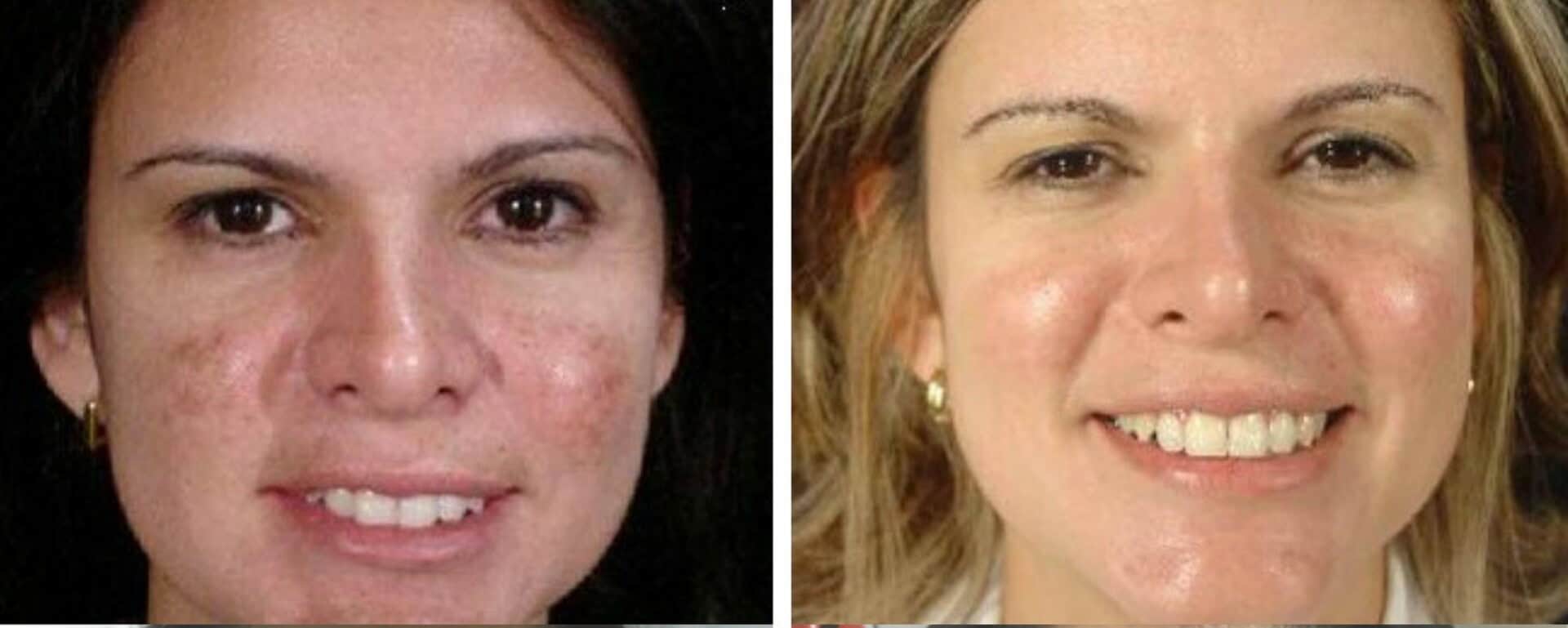 Cosmelan Depigmentation Peel | London Premier Laser Clinic