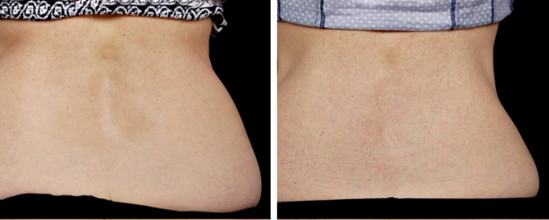 CoolSculpting | Fat Freezing | London Premier Laser Clinic
