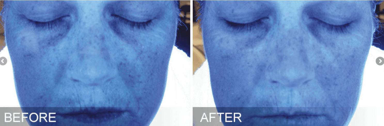 Hydrafacial Before and After Photos - London Premier Laser & Skin Clinic