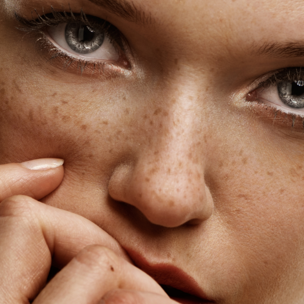 Skin Pigmentation Treatment | London Premier Laser Clinic