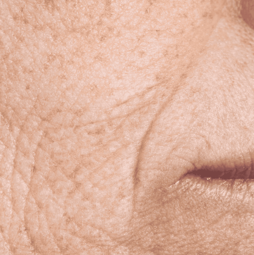 Loose Skin Treatment - London Premier Laser & Skin Clinic