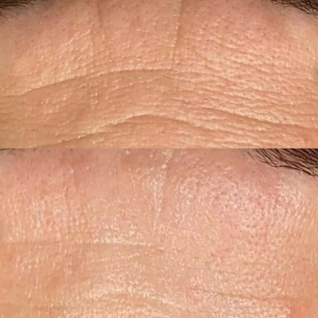 LED Light Therapy - London Premier Laser & Skin Clinic