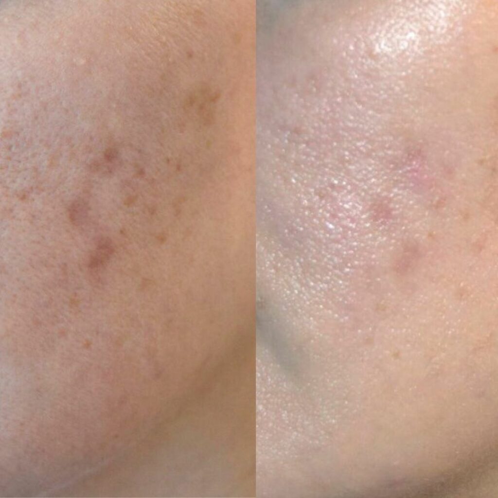 Exosomes Treatment | London Premier Laser & Skin Clinic
