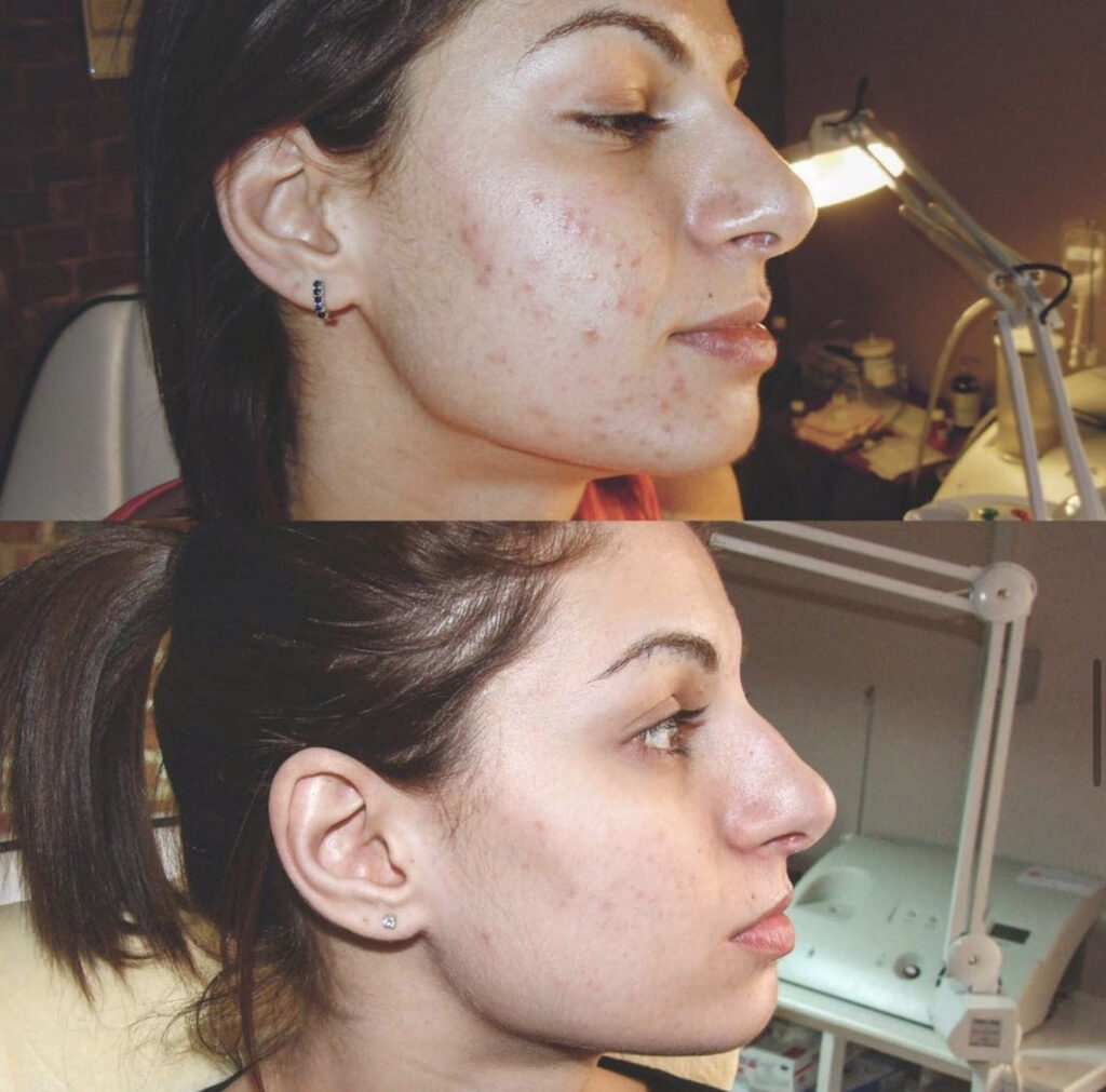 Exosomes Treatment | London Premier Laser & Skin Clinic