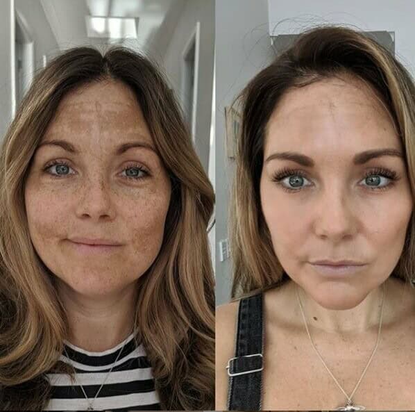 Before & Afters - London Premier Laser & Skin Clinic