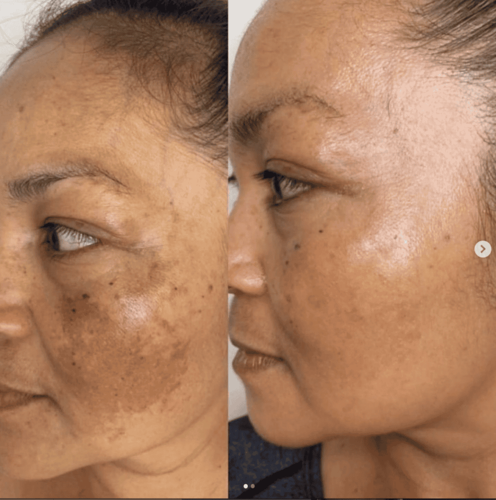 Hyperpigmentation Treatment London Premier Laser Skin Clinic