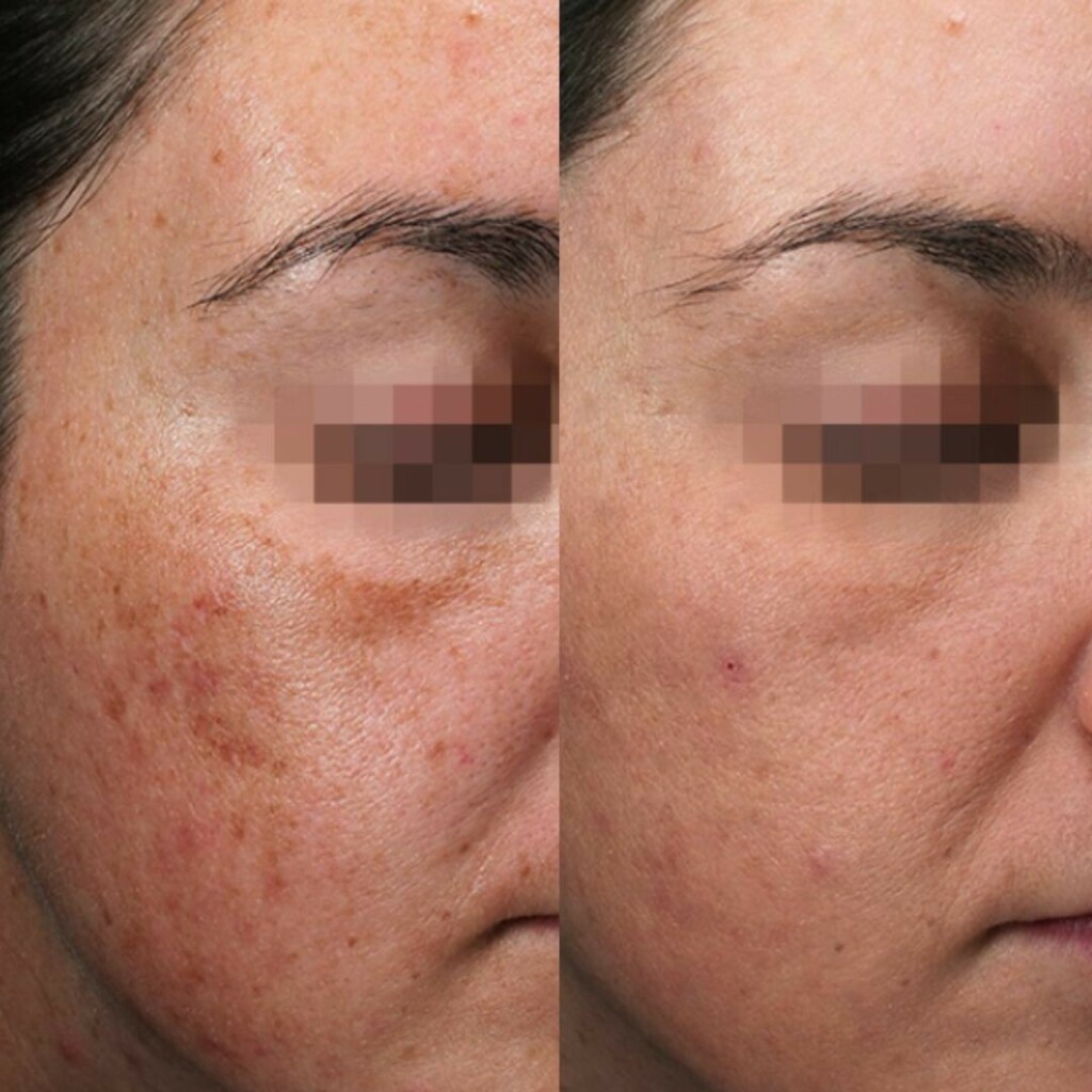 Picosure Pro Laser | London Premier Laser Clinic