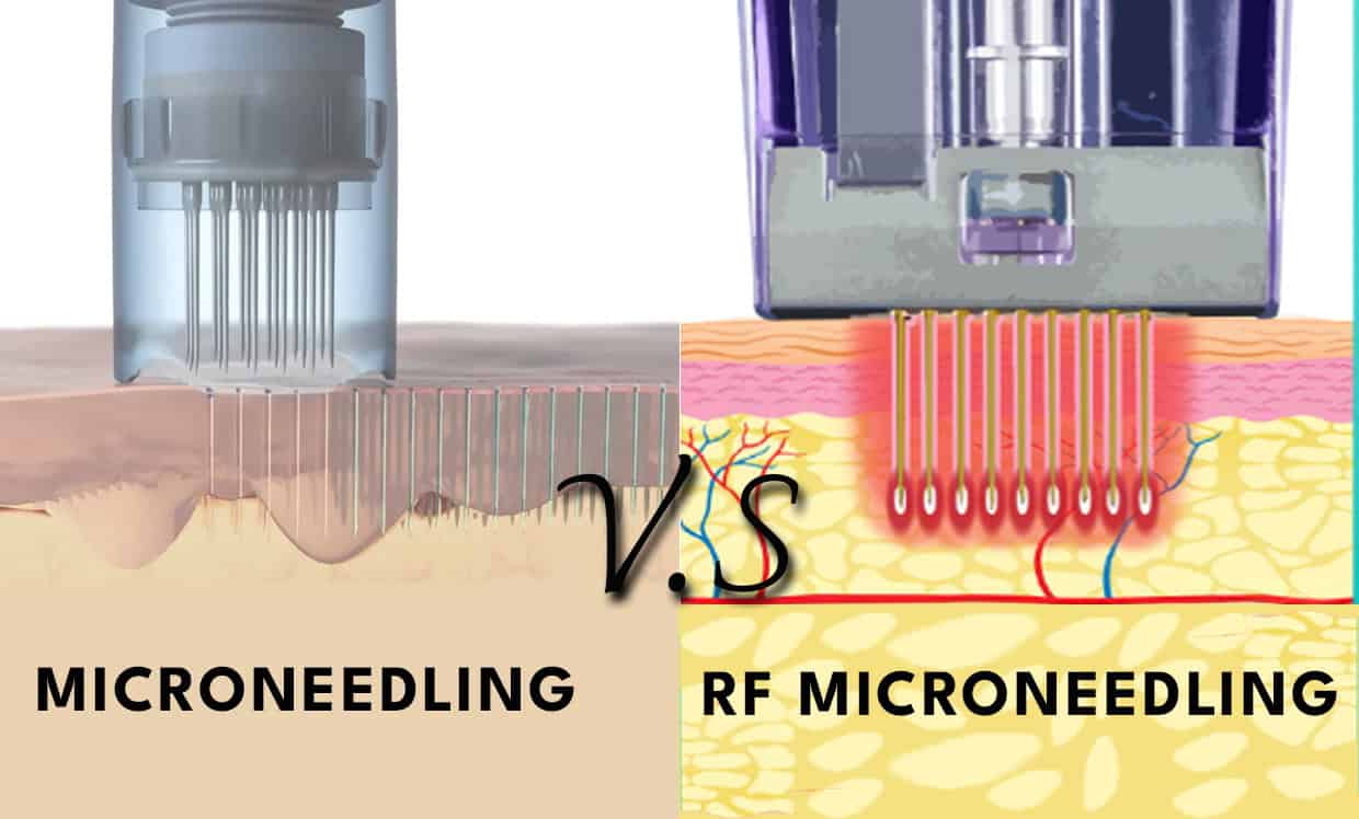 Microneedling vs RF Microneedling - London Premier Laser & Skin Clinic