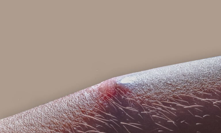 Can You Squeeze an Ingrown Hair Out? - London Premier Laser & Skin Clinic