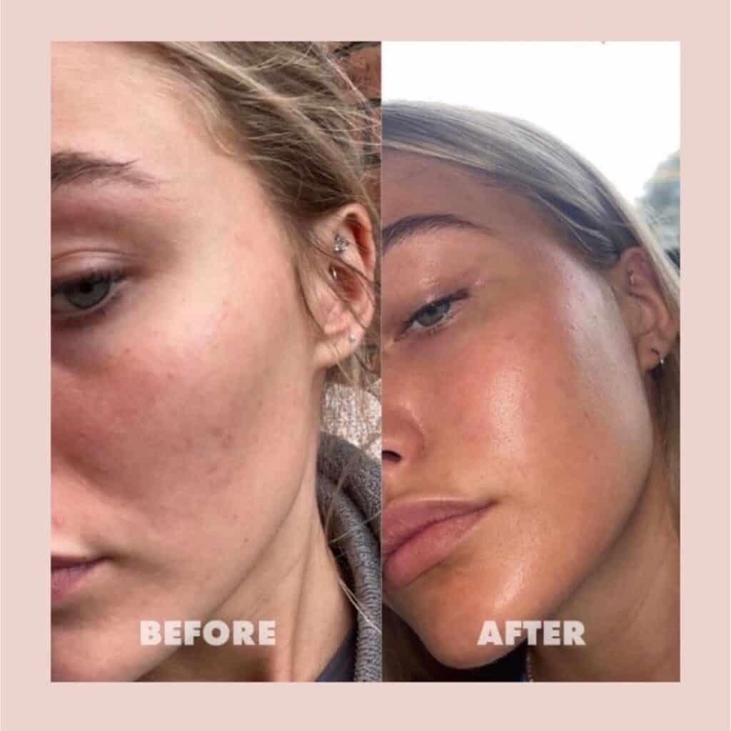 Lumi Pro Injections | London Premier Laser & Skin Clinic