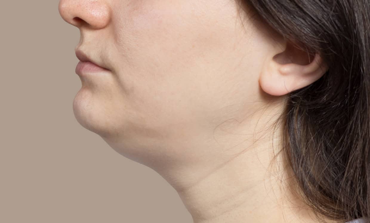 How Long Does CoolSculpting Last on a Double Chin? - London Premier ...