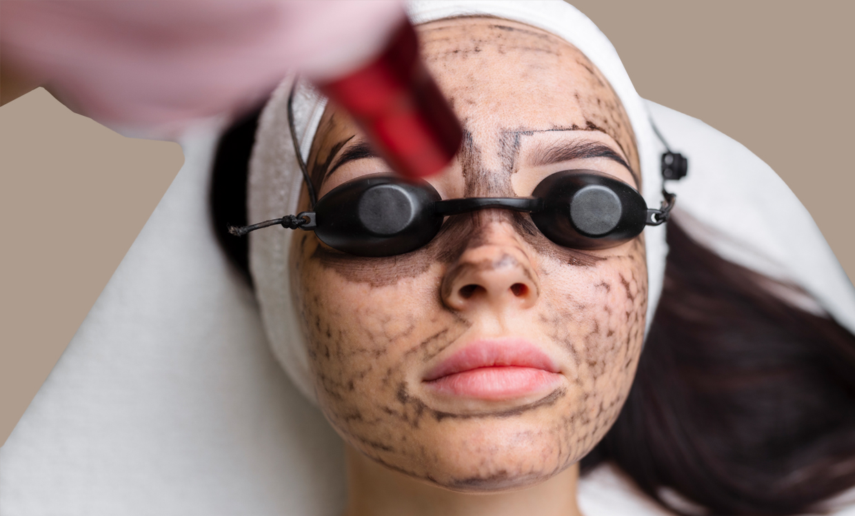 Is Carbon Facial Better Than Microneedling? - London Premier Laser ...