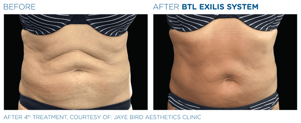 Exilis - London Premier Laser & Skin Clinic