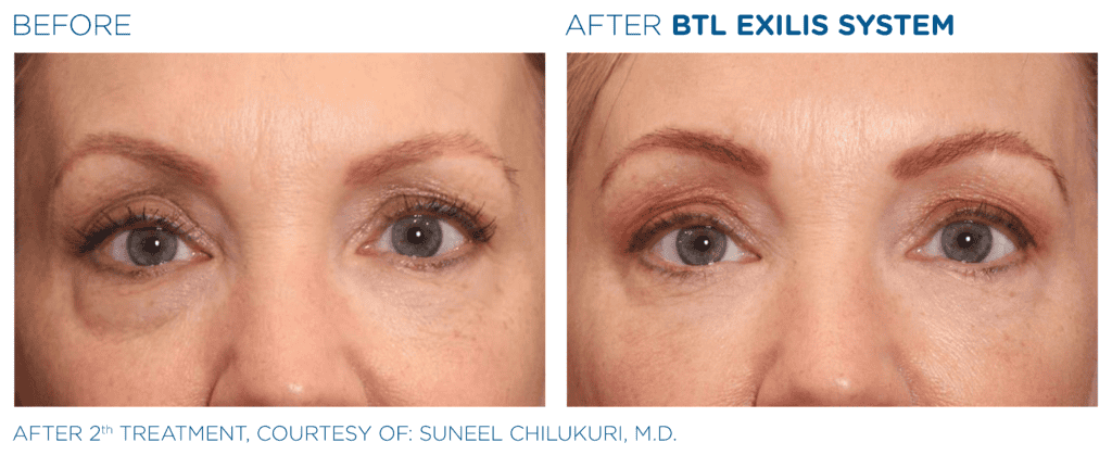 Exilis - London Premier Laser & Skin Clinic