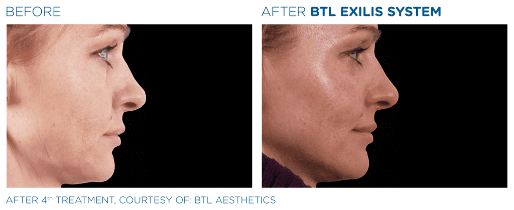 Exilis - London Premier Laser & Skin Clinic