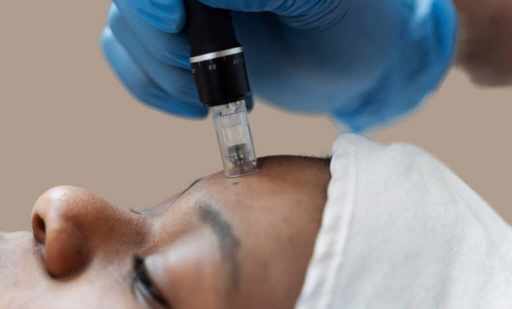 How Often Should I Do Microneedling with Exosomes? - London Premier ...