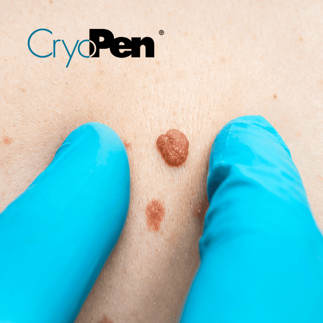 CryoPen Treatment - London Premier Laser & Skin Clinic