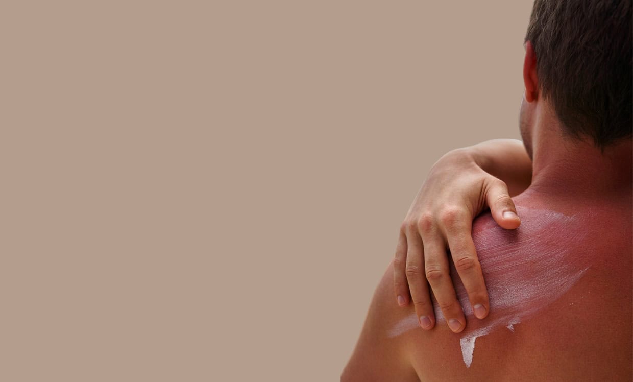 A Complete Guide to Treating Sunburns - London Premier Laser & Skin Clinic