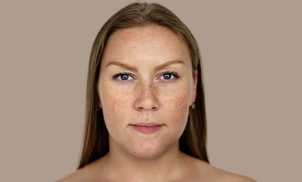 Can You Reverse Pigmentation on Your Face? - London Premier Laser ...
