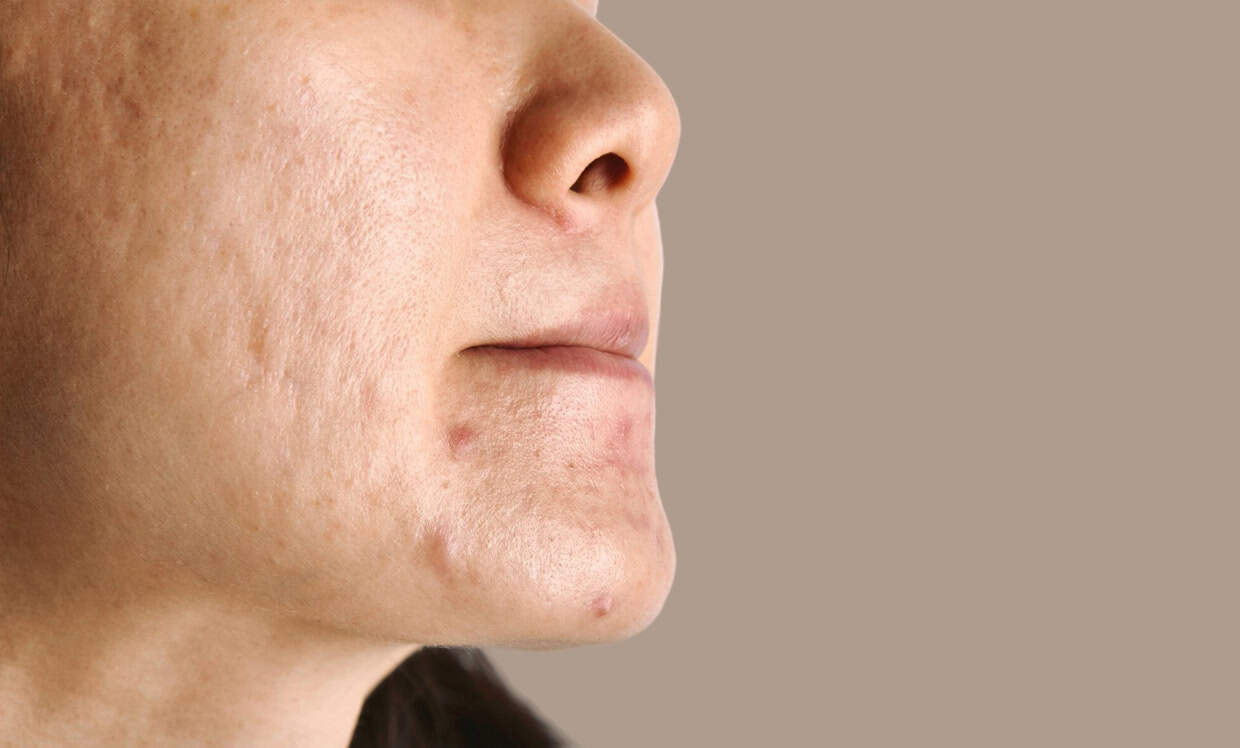 Which Is Better for Acne Scars: Microneedling or Laser? - London ...