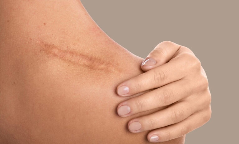 How to Get Surgical Scars to Fade - London Premier Laser & Skin Clinic